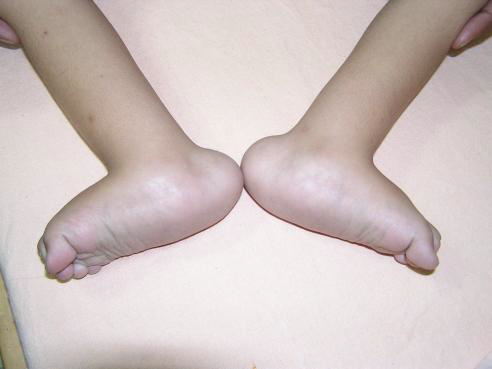 Rocker bottom Feet – OrthoPed