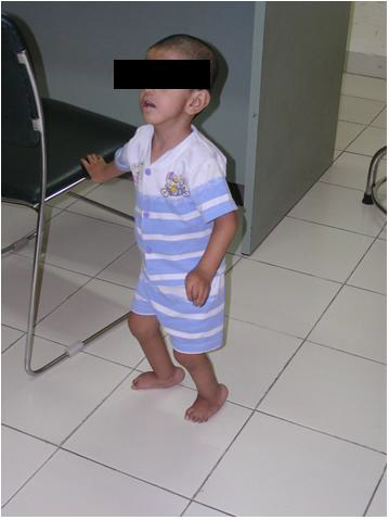 Rocker bottom Feet – OrthoPed