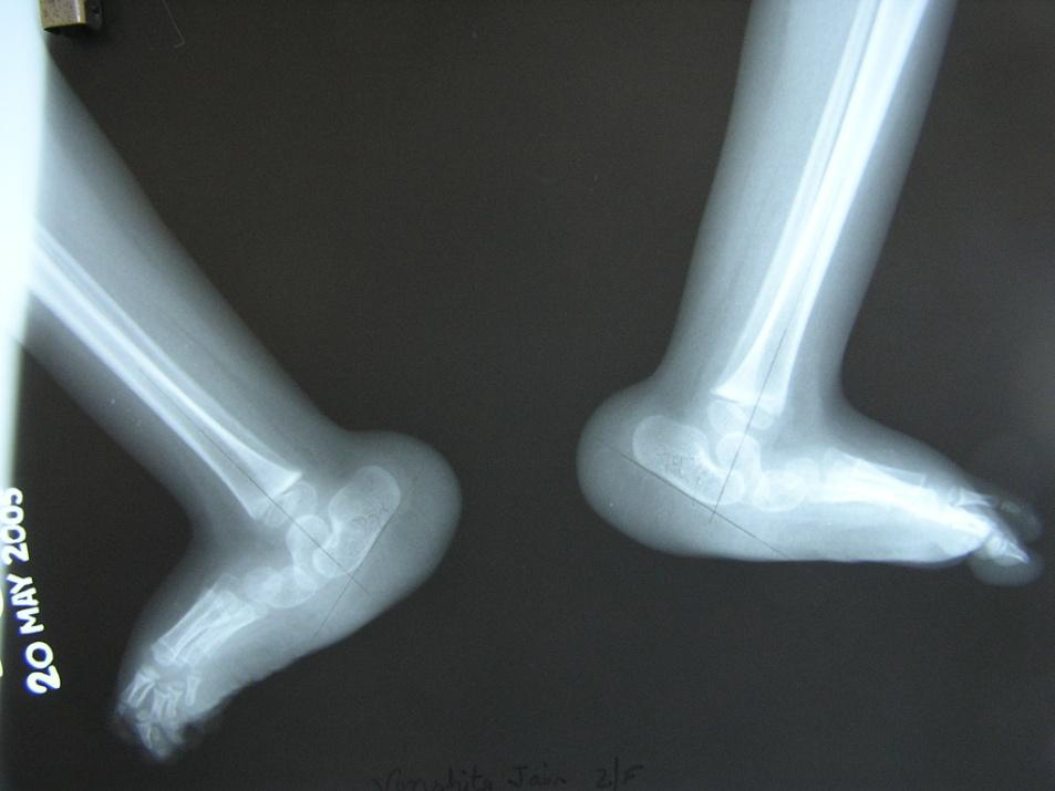 Rocker bottom Feet – OrthoPed