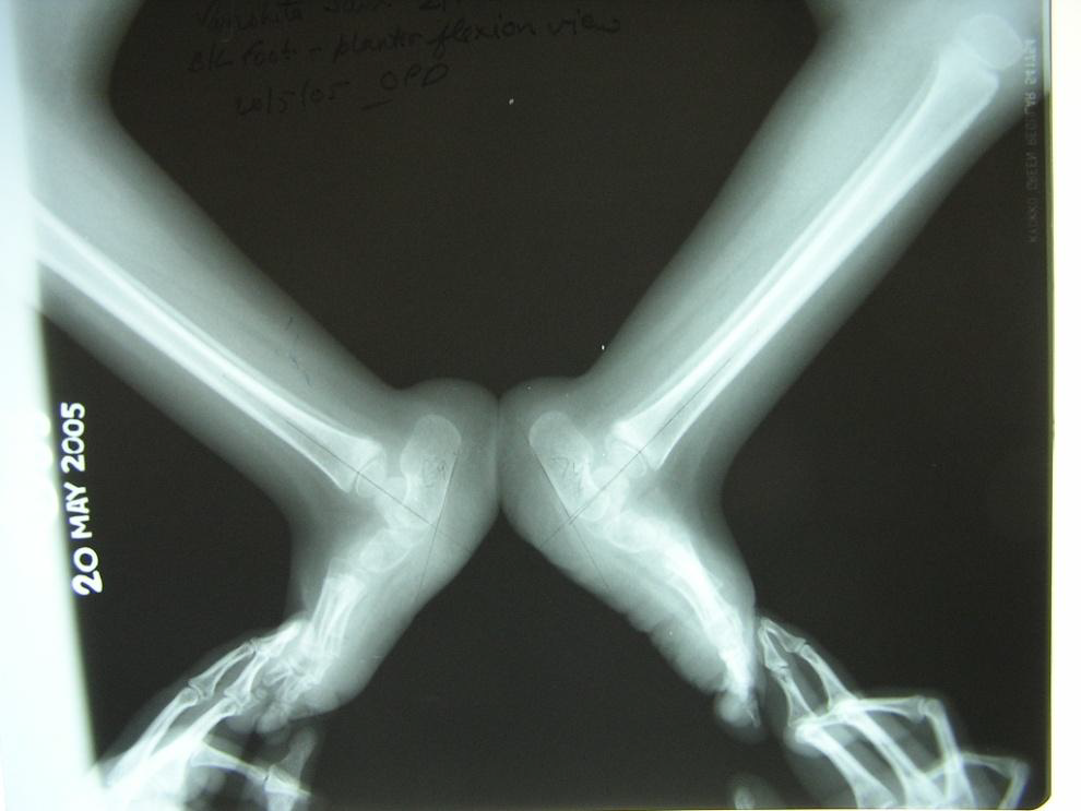 Rocker bottom Feet – OrthoPed