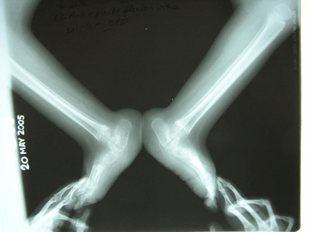 Rocker bottom Feet – OrthoPed