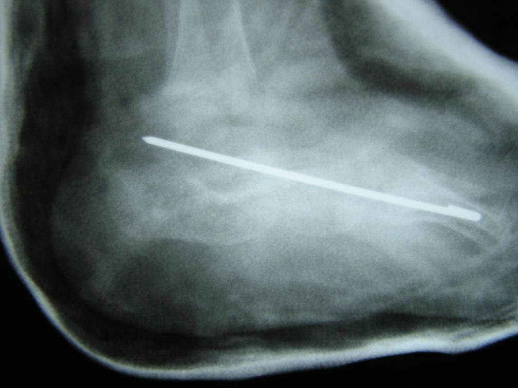 Rocker bottom Feet – OrthoPed