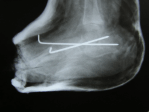 Rocker bottom Feet – OrthoPed