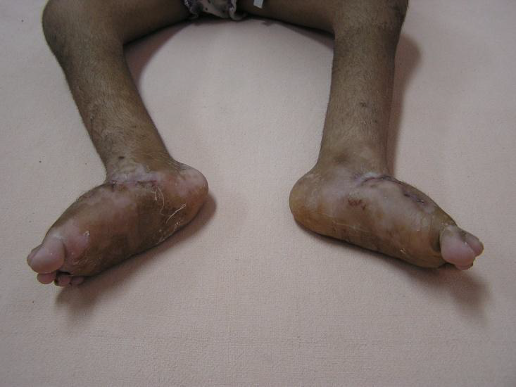 Rocker bottom Feet – OrthoPed