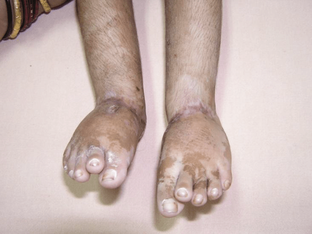 Rocker bottom Feet – OrthoPed